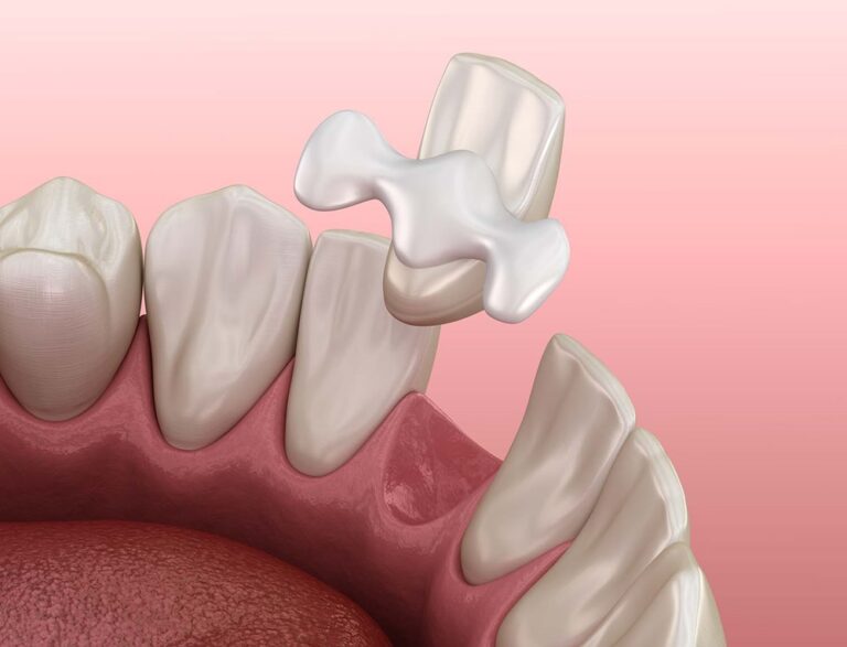 How Much Does a Single Tooth Bridge Cost?